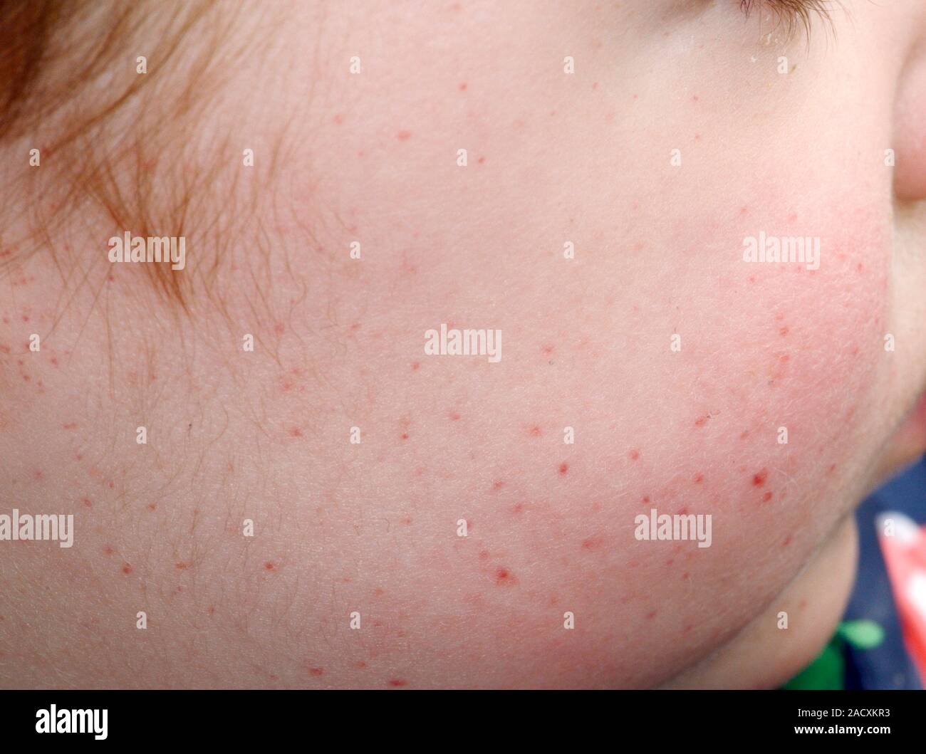 Not for use in Television Not for use in Television Purpuric rash of ...