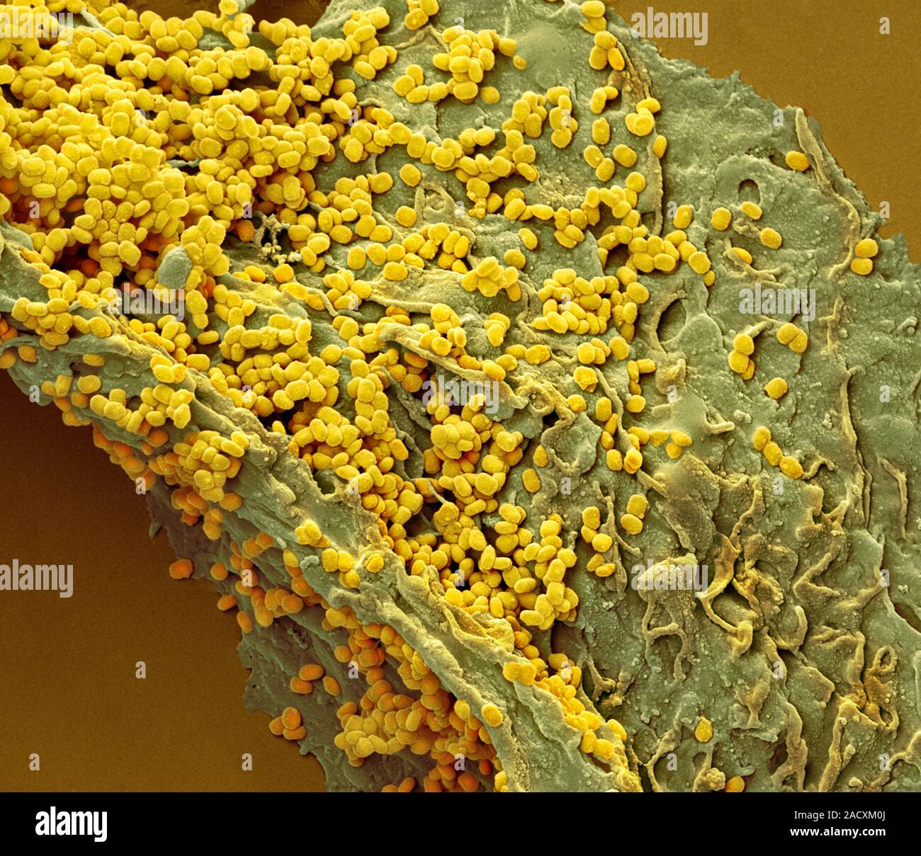 Molluscum contagiosum, coloured electron micrograph (SEM). Molluscum ...