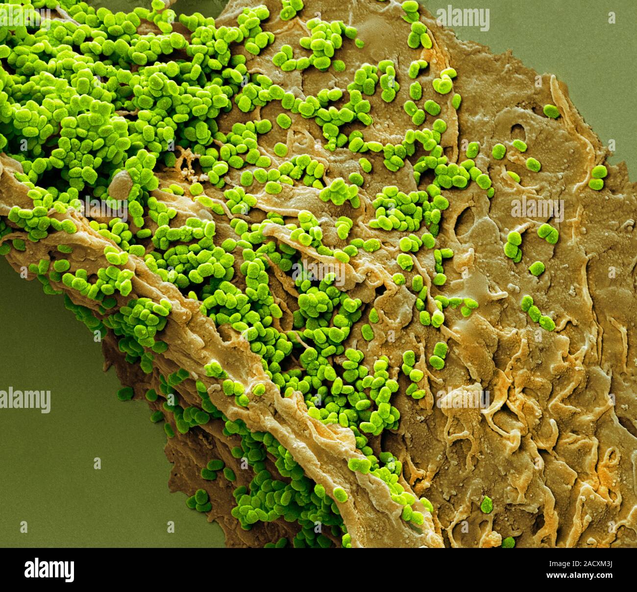 Molluscum Contagiosum Coloured Electron Micrograph Sem Molluscum Contagiosum Is A Viral