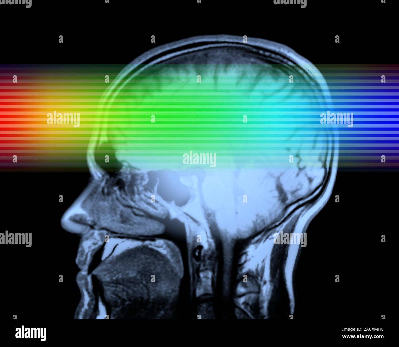 Normal brain. Coloured magnetic resonance imaging (MRI) scan of a side view of a healthy brain ...