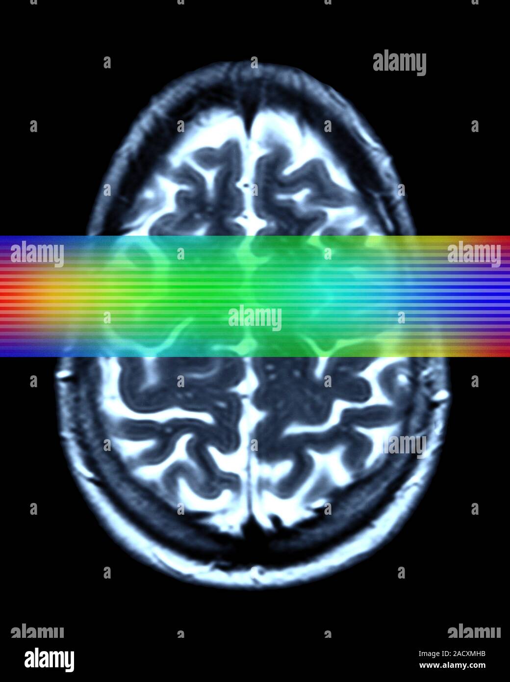 Normal brain. Coloured magnetic resonance imaging (MRI) scan of an axial section through a ...