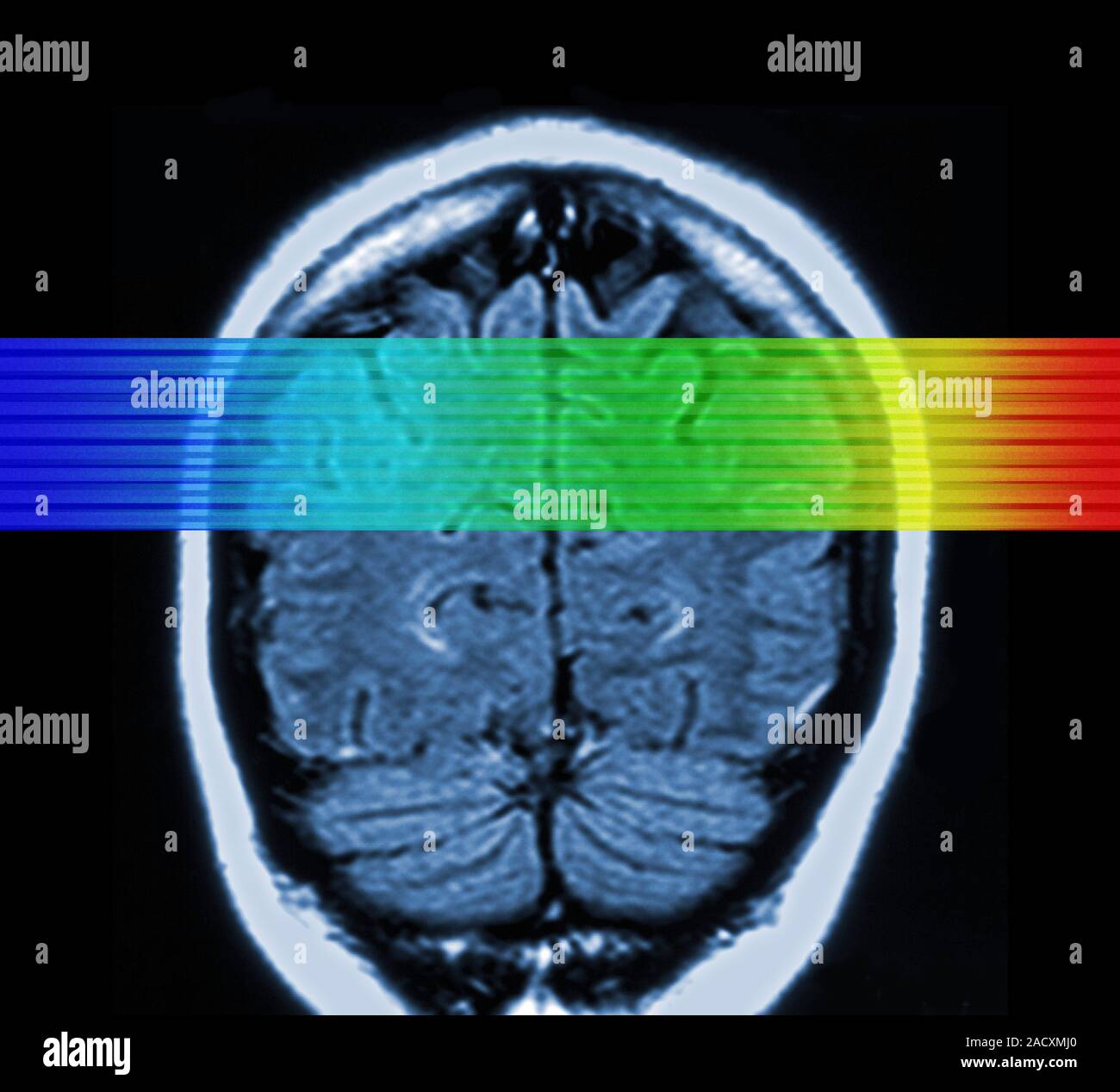 Healthy Brain Slice Brain Healthy Meal: Broccoli And Sun Dried Tomato