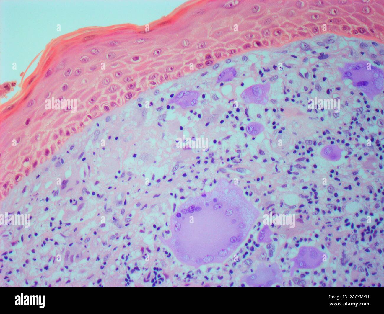 Juvenile xanthogranuloma. Light micrograph of affected skin from a ...