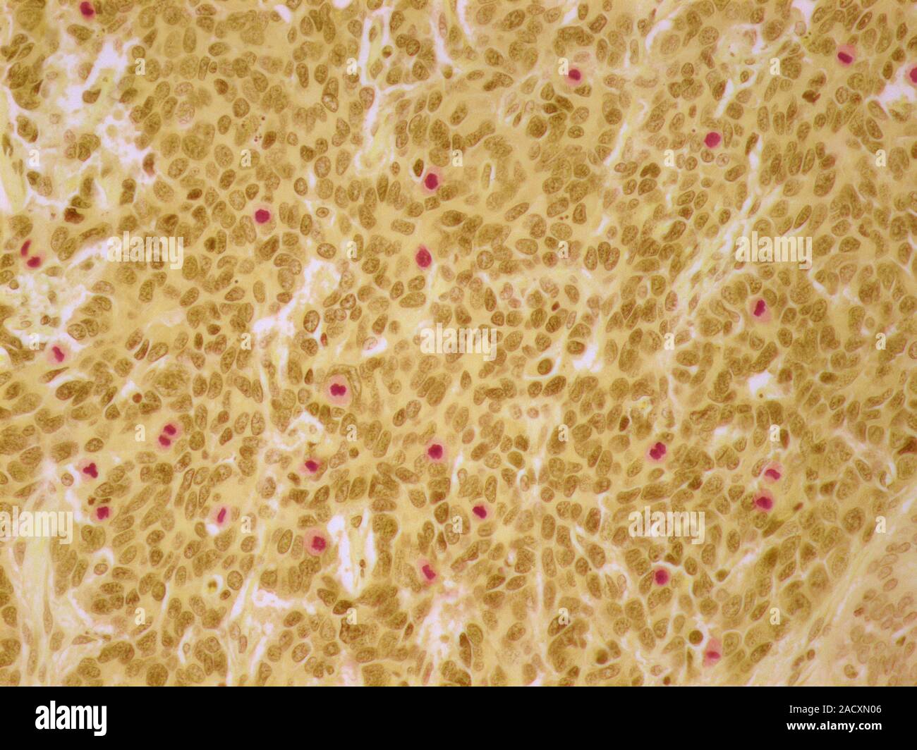 Cervical cancer. Light micrograph (LM) of a section of a large cell ...