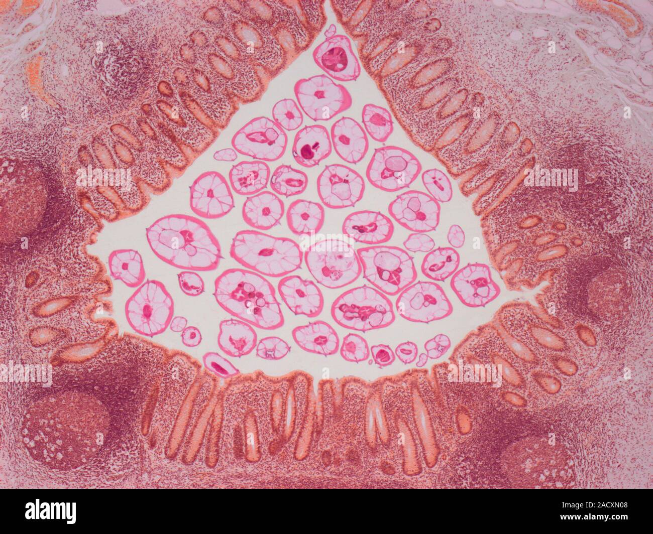 Appendicitis due to threadworm (Enterobius vermicularis) infection ...