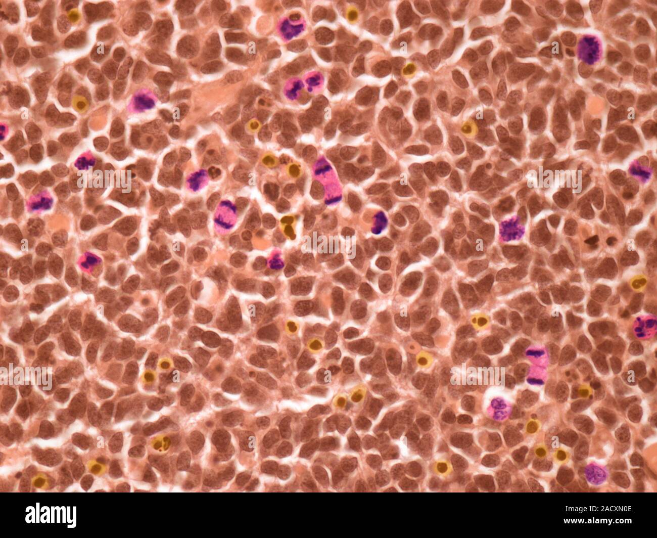 Primitive Neuroectodermal Tumor Light Micrograph Lm Of A Section Of