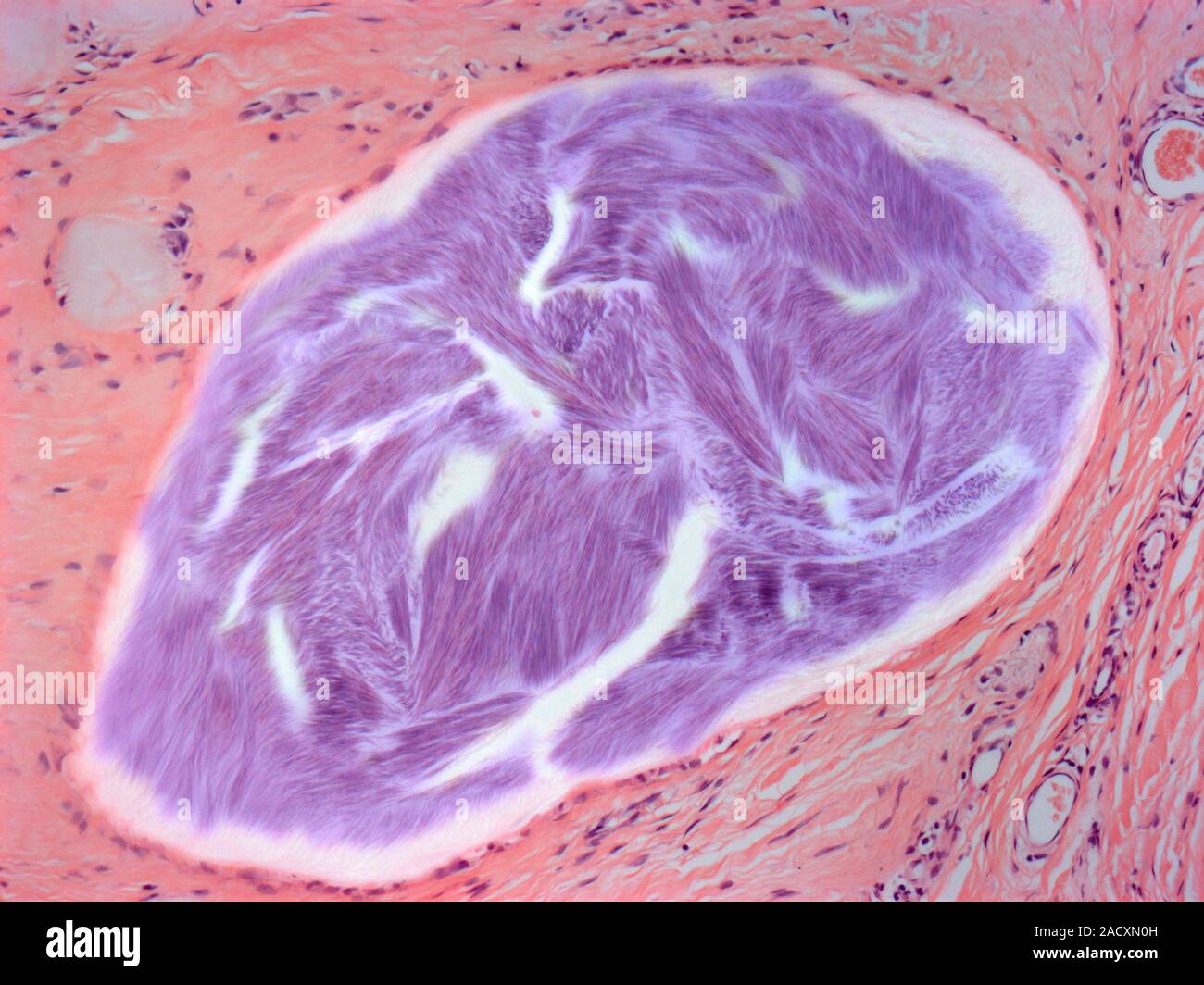 Gout. Light micrograph (LM) of a section of urate crystals in the toe ...