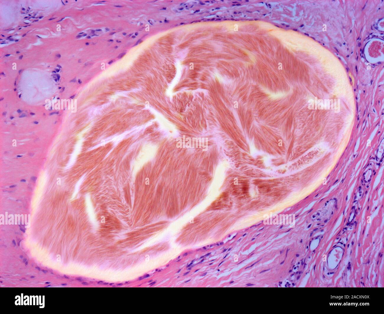 Gout. Light micrograph (LM) of a section of urate crystals in the toe ...