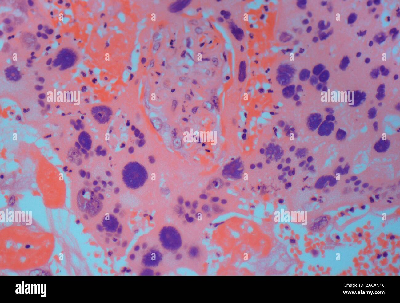 Uterine cancer. Light micrograph (LM) of a section of a choriocarcinoma ...