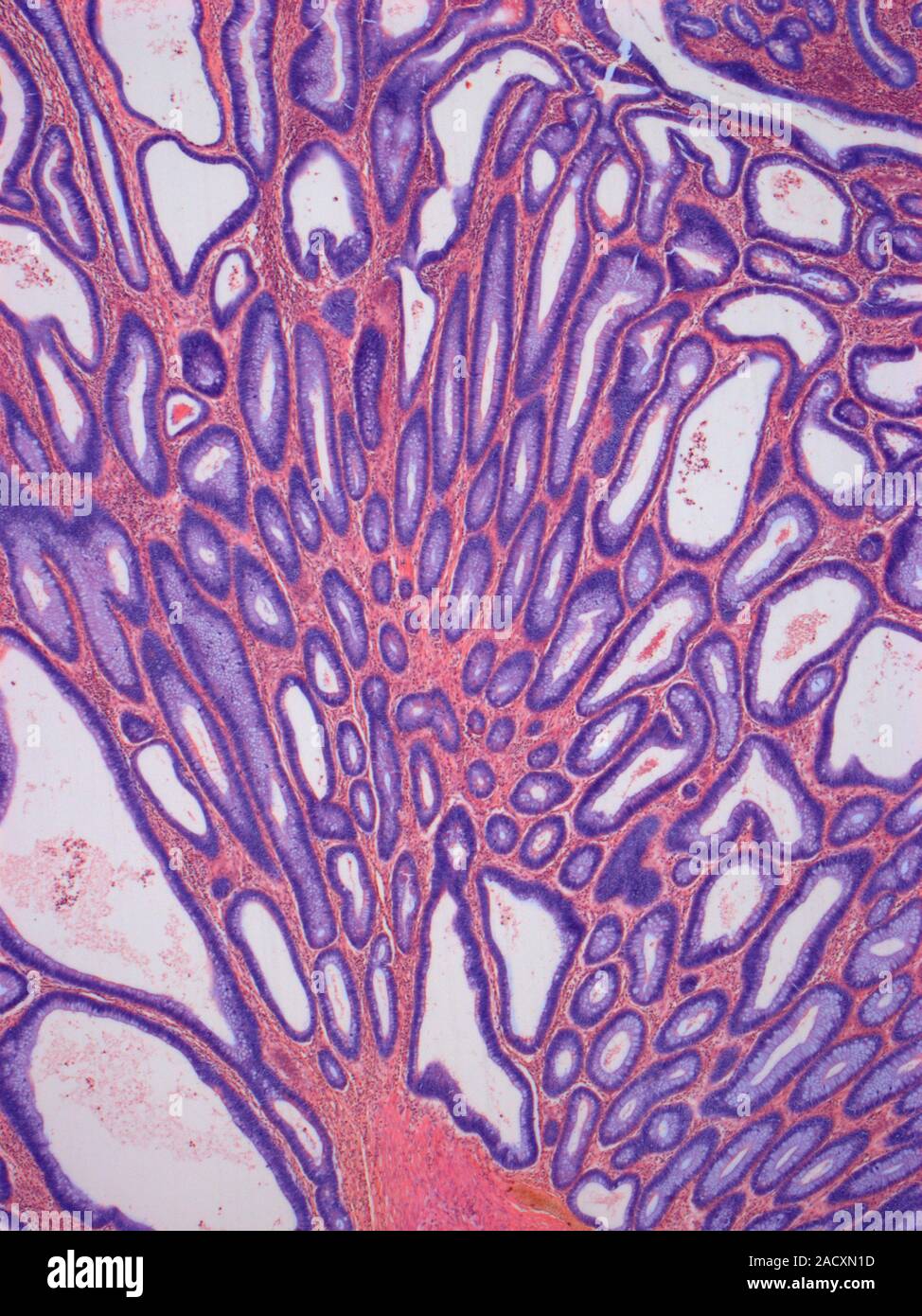 Adenoma of colon. Light micrograph (LM) of affected human gut. Adenomas ...