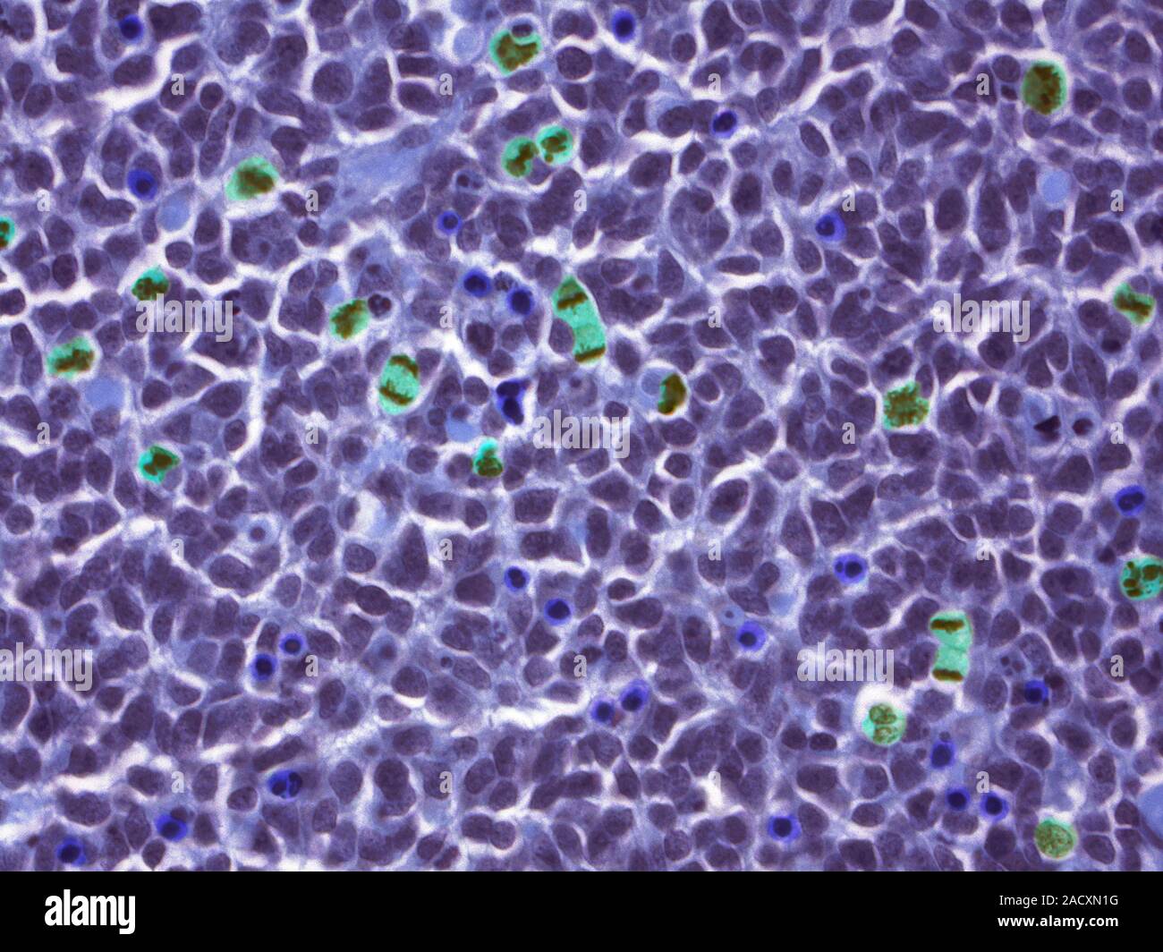 Primitive Neuroectodermal Tumor Light Micrograph Lm Of A Section Of Affected Brain Primitive