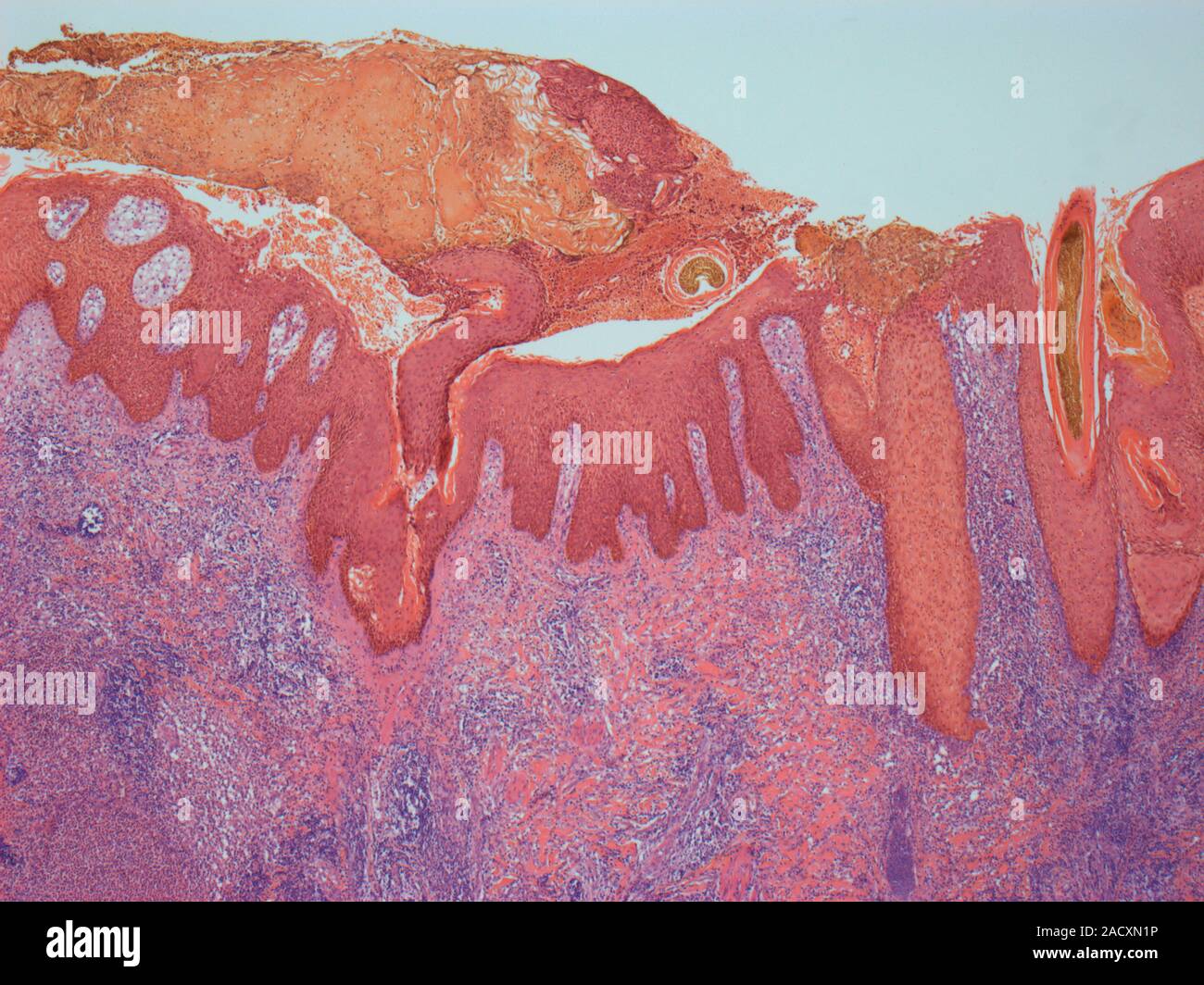 Ringworm. Light micrograph (LM) of a section of tinea capitis. Tinea ...
