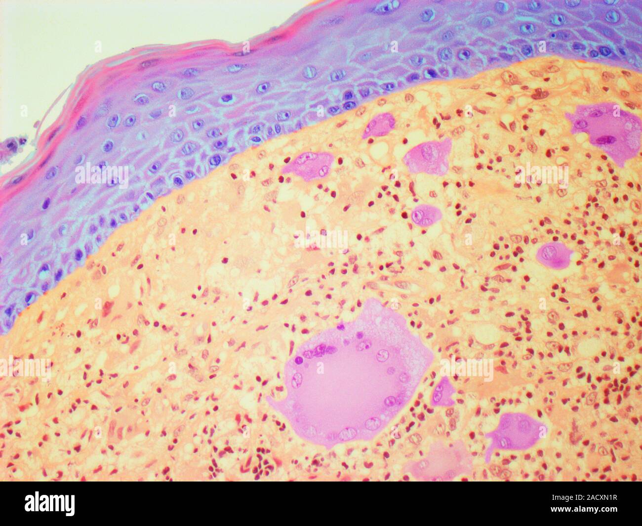 Juvenile Xanthogranuloma Light Micrograph Of Affected Skin From A