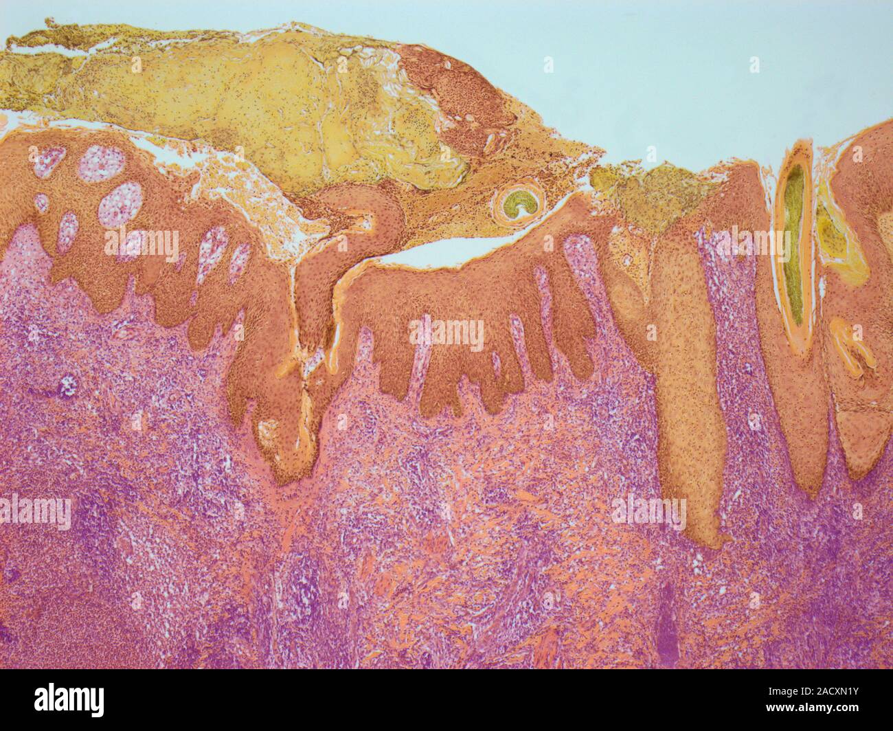 LM Tinea capitis Tinea capitis is a fungal infection of the scalp. It ...
