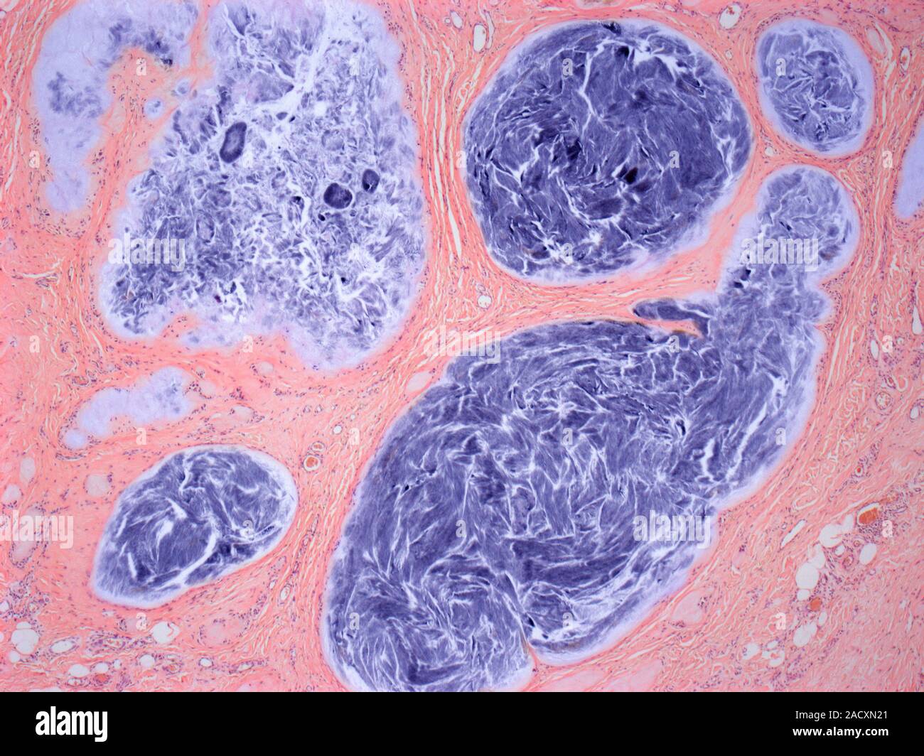 Gout. Light micrograph (LM) of a section of urate crystals in the toe ...