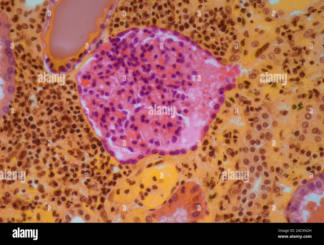 Lymphoproliferative disease. Light micrograph (LM) of a kidney section ...