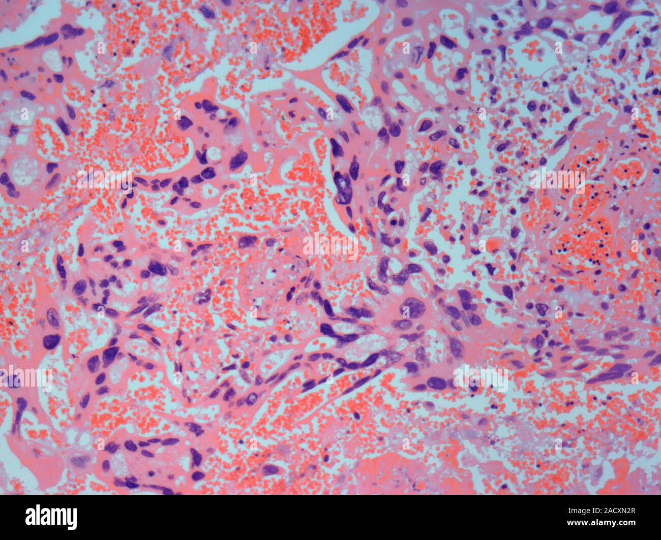 Uterine cance. Light micrograph (LM) of a section of a choriocarcinoma ...