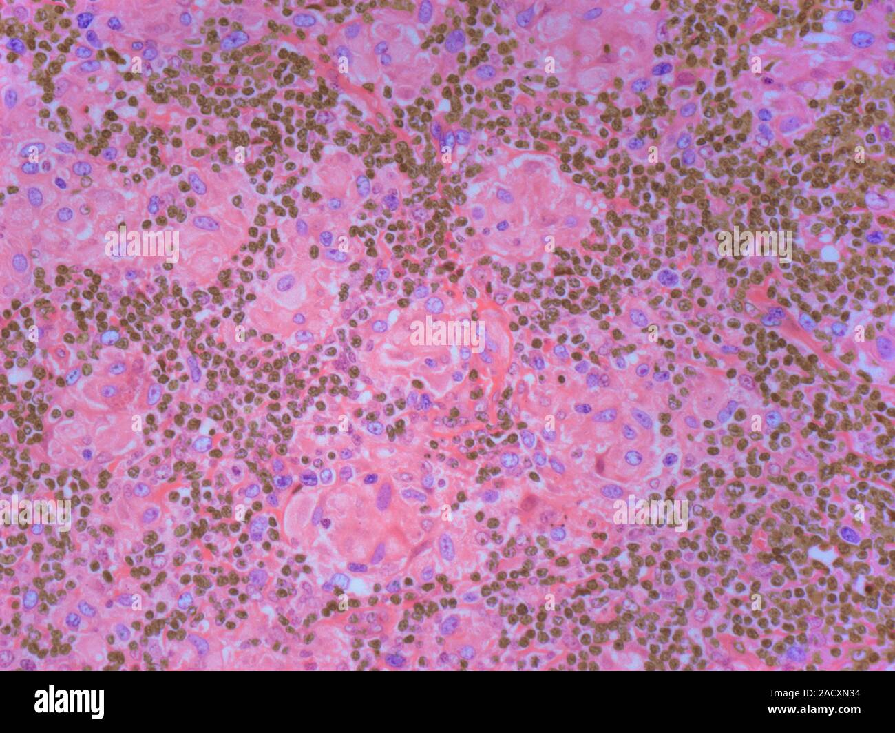 Lymphoma. Light micrograph (LM) of a section from a patient with ...