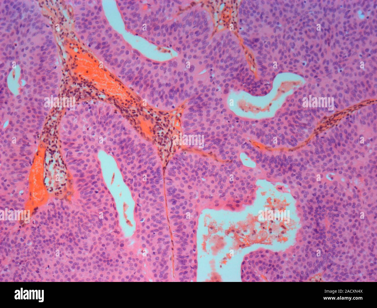 Bladder cancer. Light micrograph (LM) of a section of a bladder ...