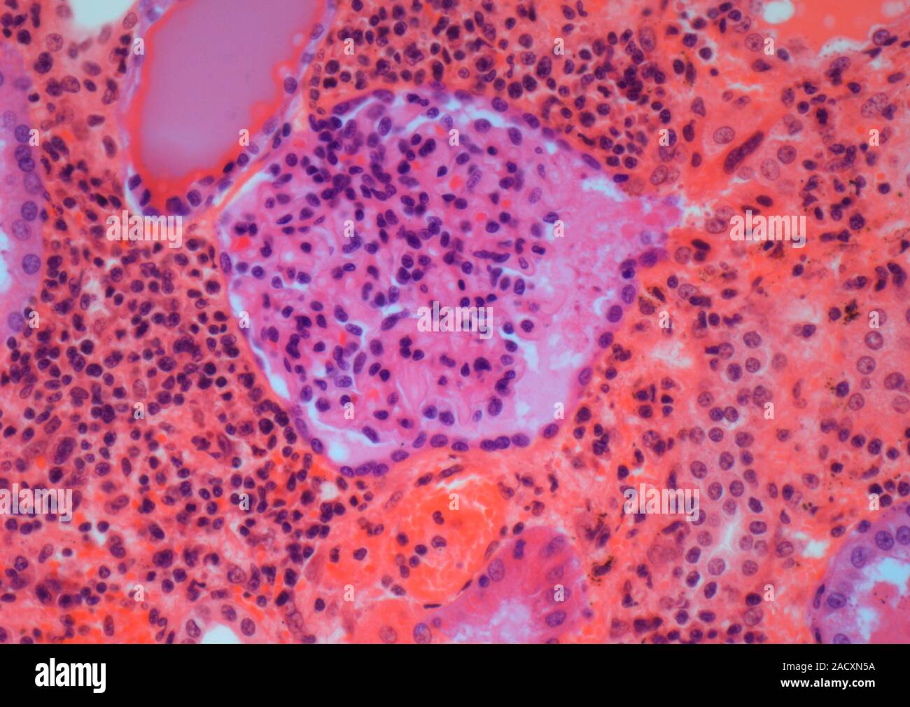 Lymphoproliferative disease. Light micrograph (LM) of a kidney section ...