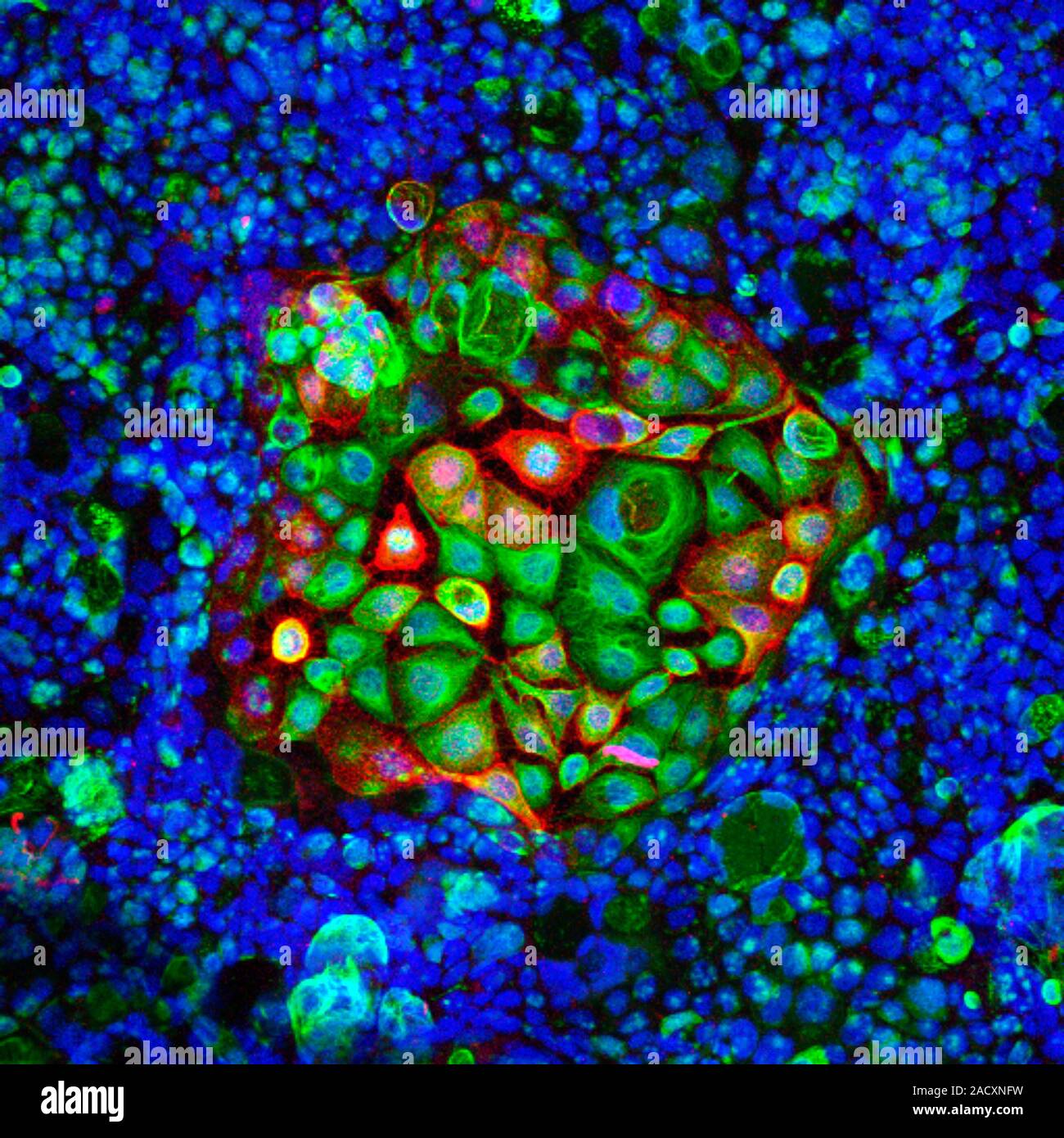 Colorectal cancer cells. Confocal light micrograph of cultured ...
