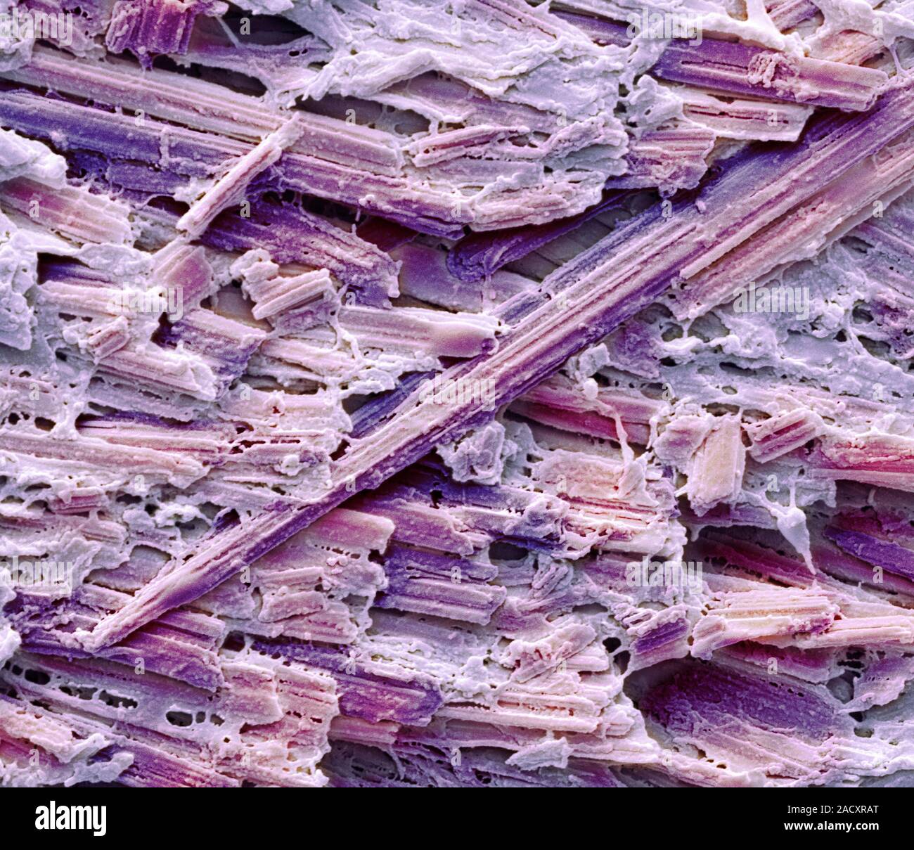 Coloured scanning electron micrograph (SEM) of uric acid crystals from ...