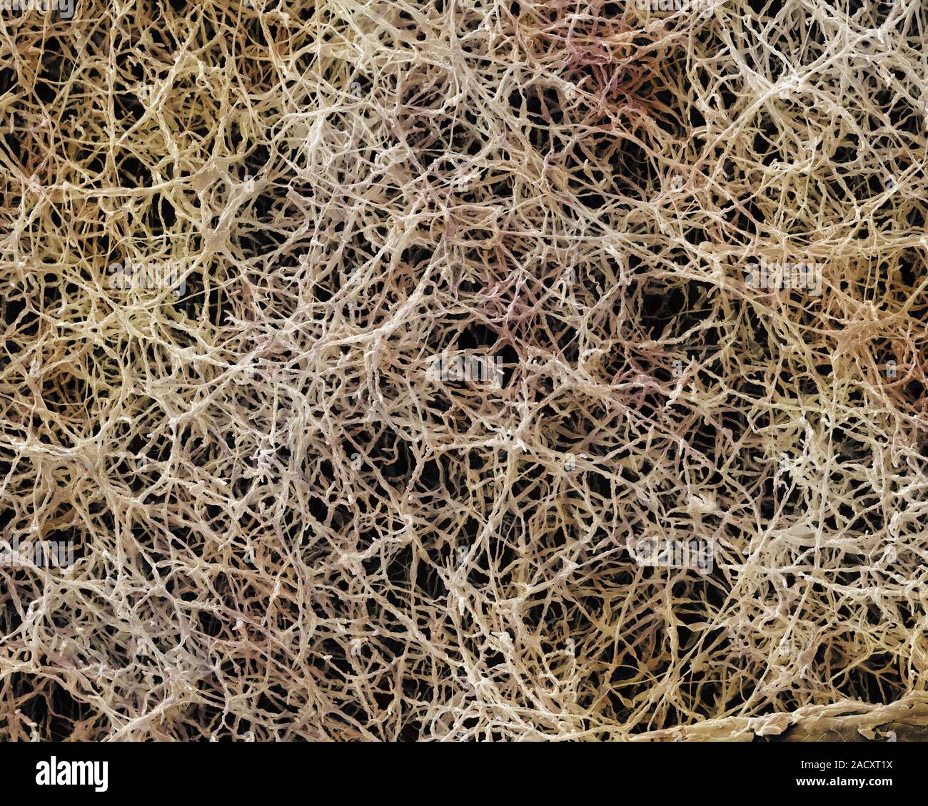 Athlete's foot fungus. Coloured scanning electron micrograph (SEM) of a ...