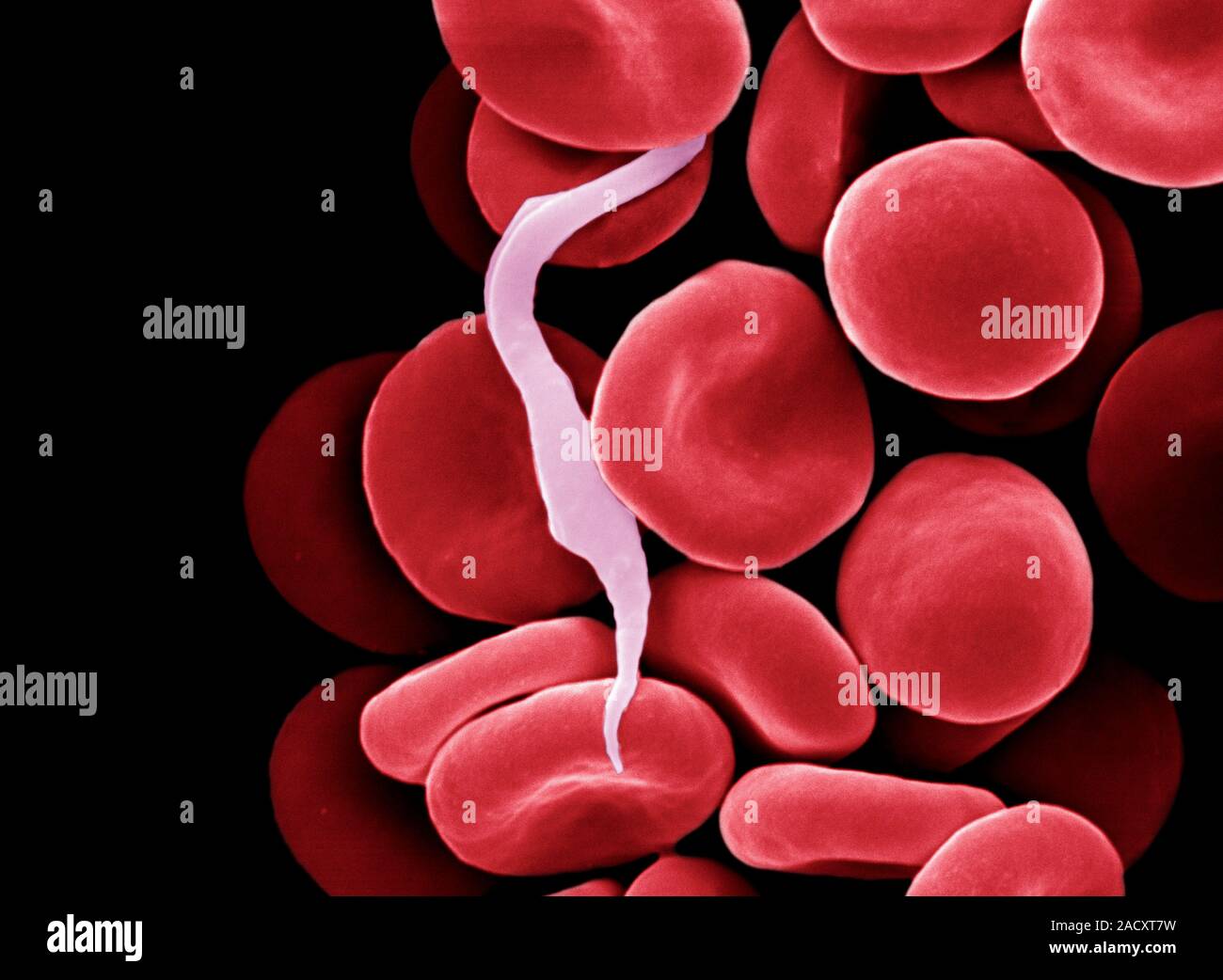 Parasitic protozoan (pink) amongst red blood cells. Coloured scanning ...