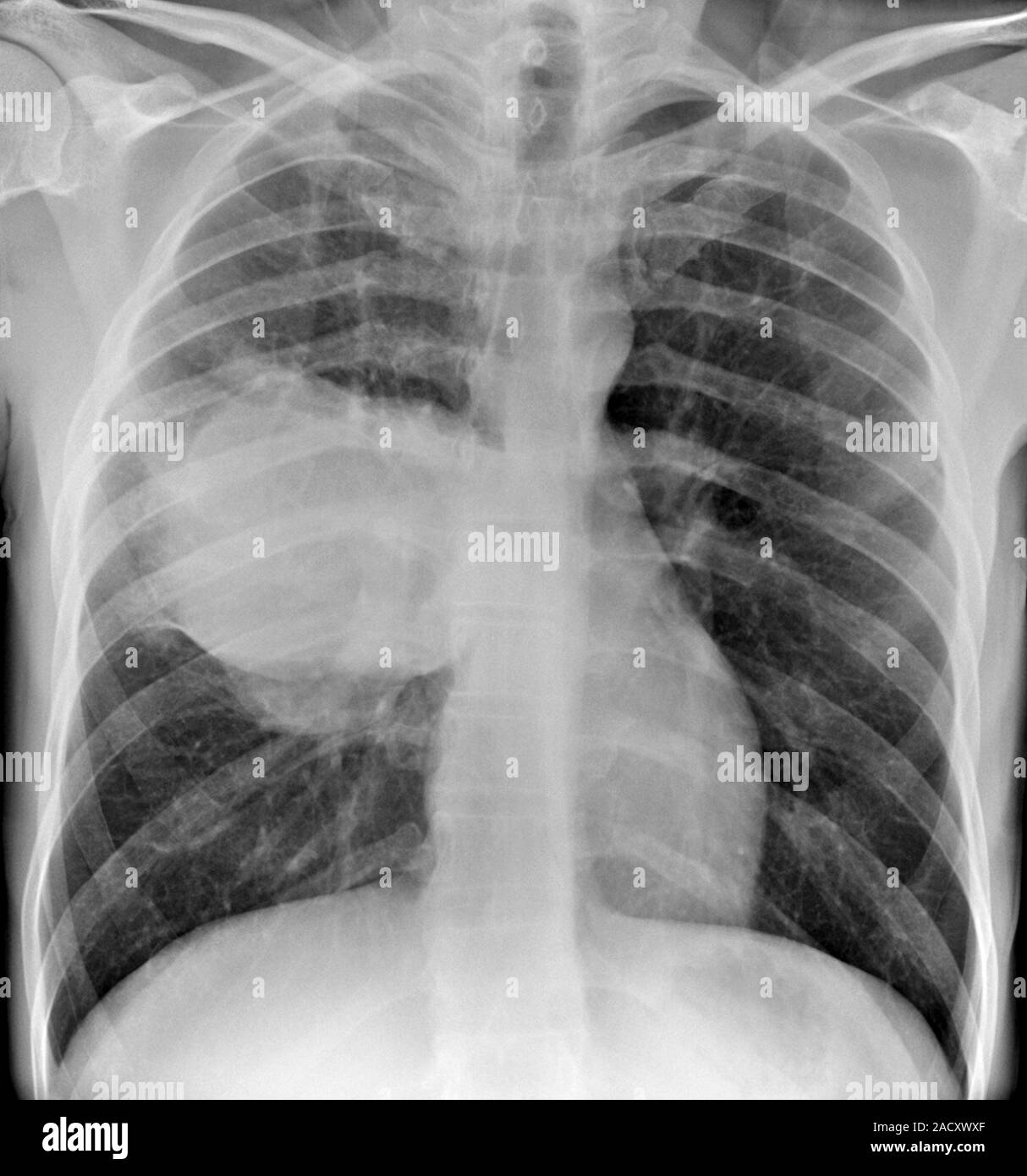 Lung cancer. Chest X-ray of a patient with lung cancer. The tumour is ...