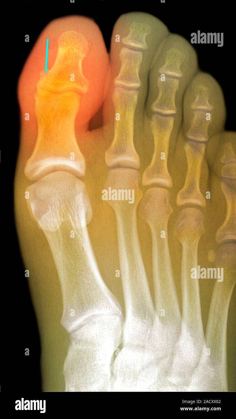 Coloured X-ray of a needle stuck in a patient's big toe Stock Photo - Alamy