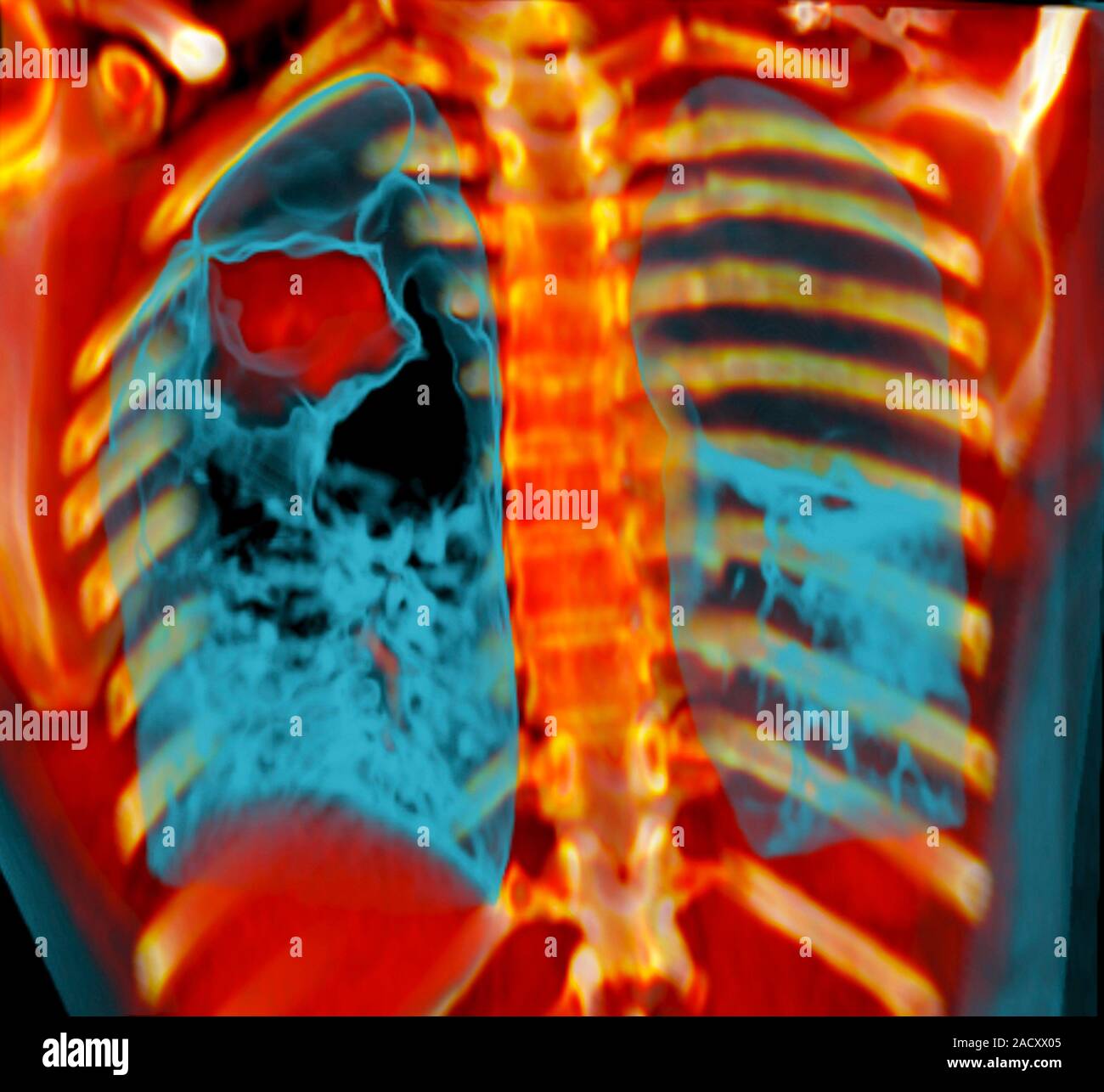 Lung cancer. Coloured computed tomography (CT) scan of a patient with ...