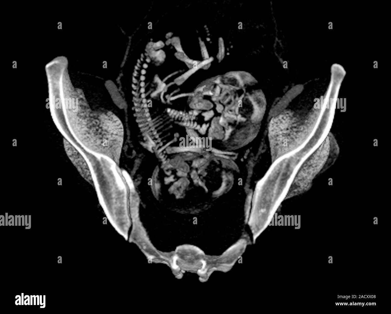 Computed tomography (CT) scan of twin foetuses in a woman's abdomen ...