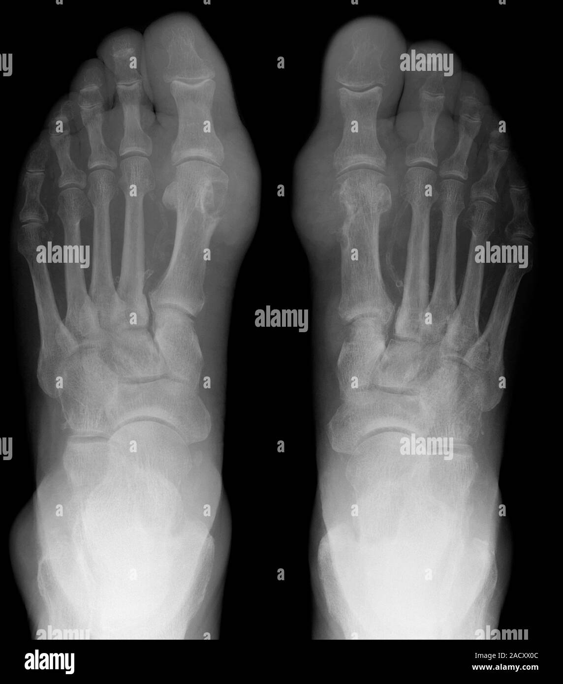 X-ray of the feet of a patient with gout. Gout is a disorder of uric ...
