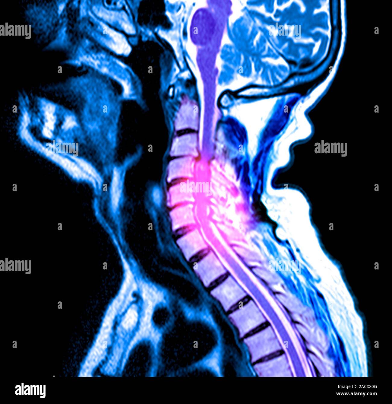 Coloured magnetic resonance imaging (MRI) scan of the cervical (neck ...
