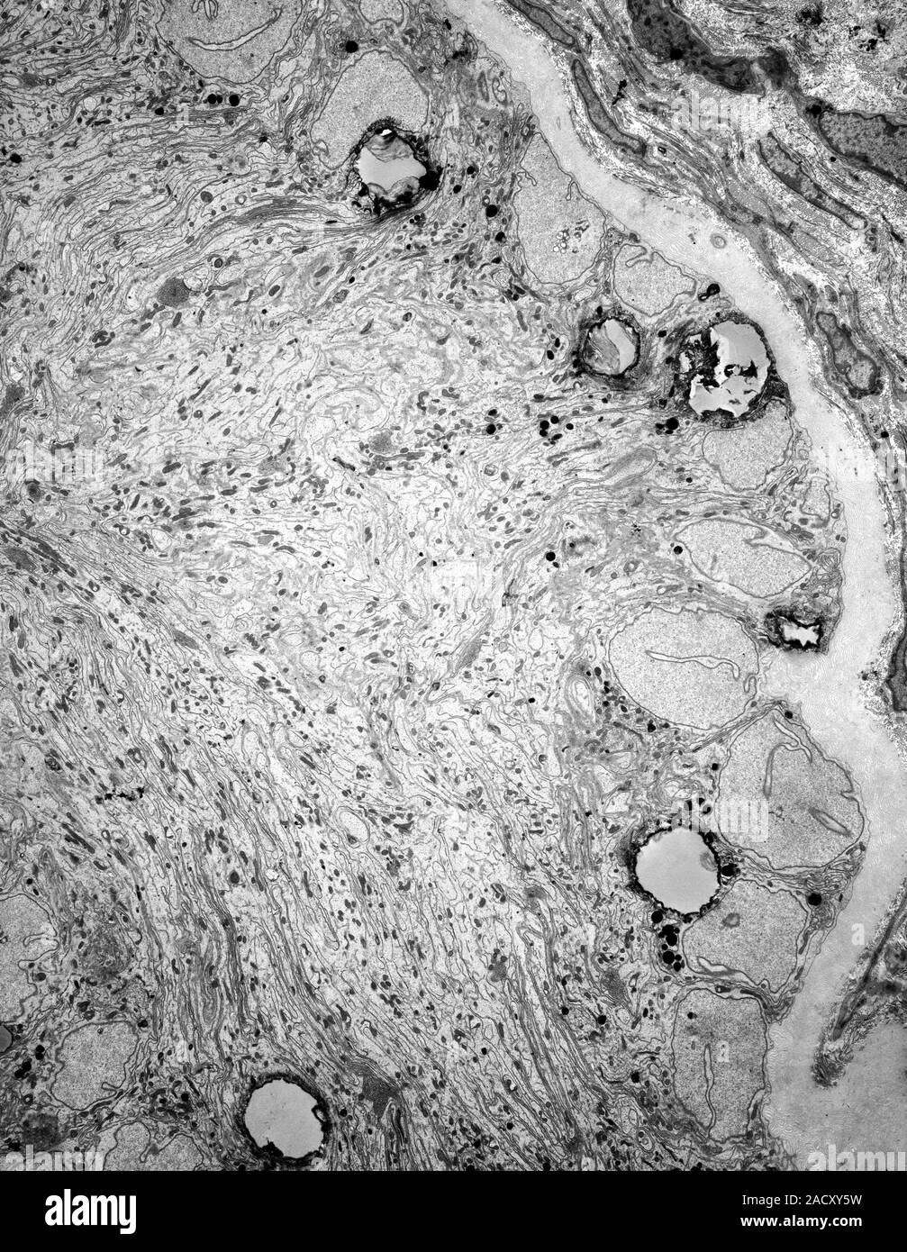 Testis Tissue In Infertility Transmission Electron Micrograph Tem Of