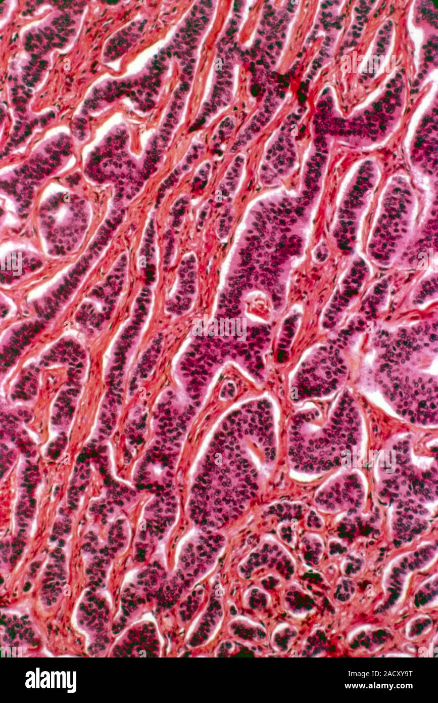 Appendix Cancer Light Micrograph Of A Section Through A Carcinoid Tumour Of The Appendix This