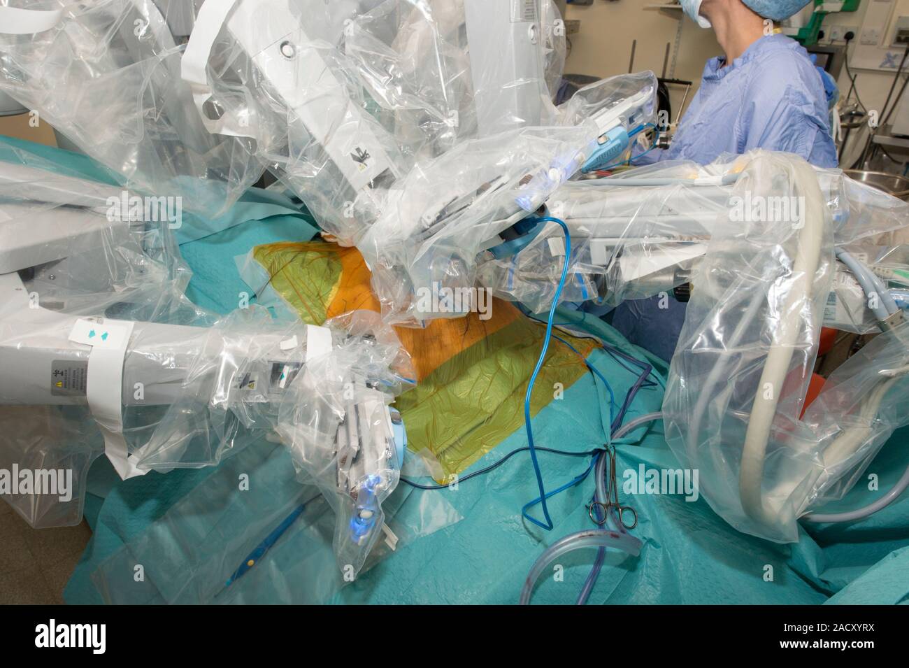 Da Vinci Robotic prostatectomy (removal of all or part of the prostate ...