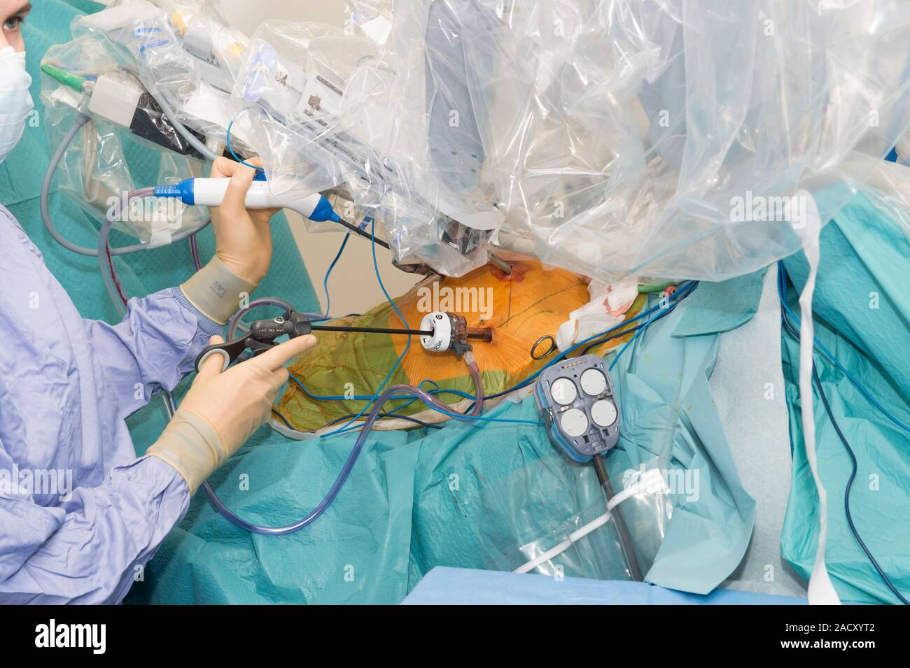 Da Vinci Robotic prostatectomy (removal of all or part of the prostate ...