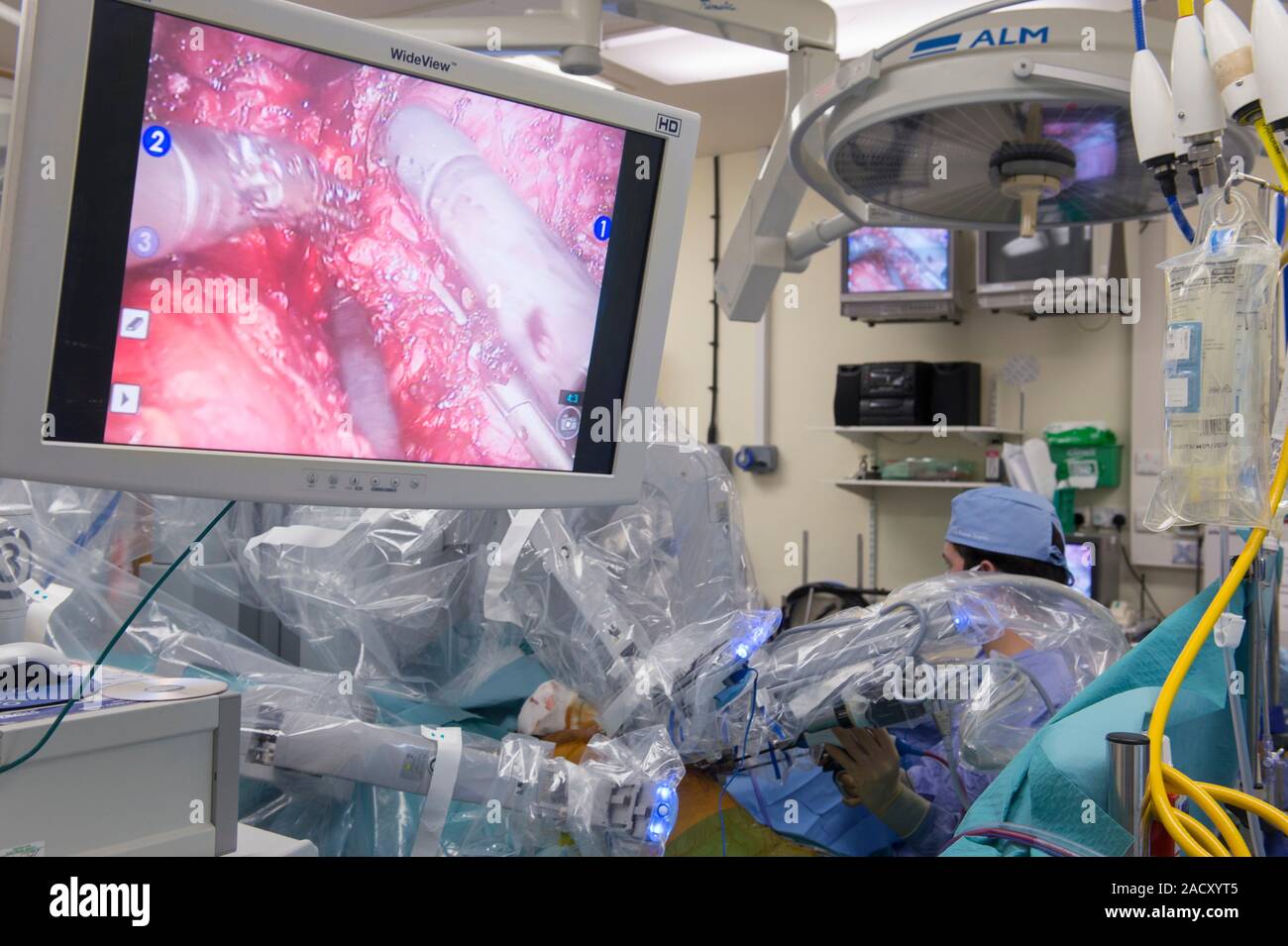 Da Vinci Robotic prostatectomy (removal of all or part of the prostate ...