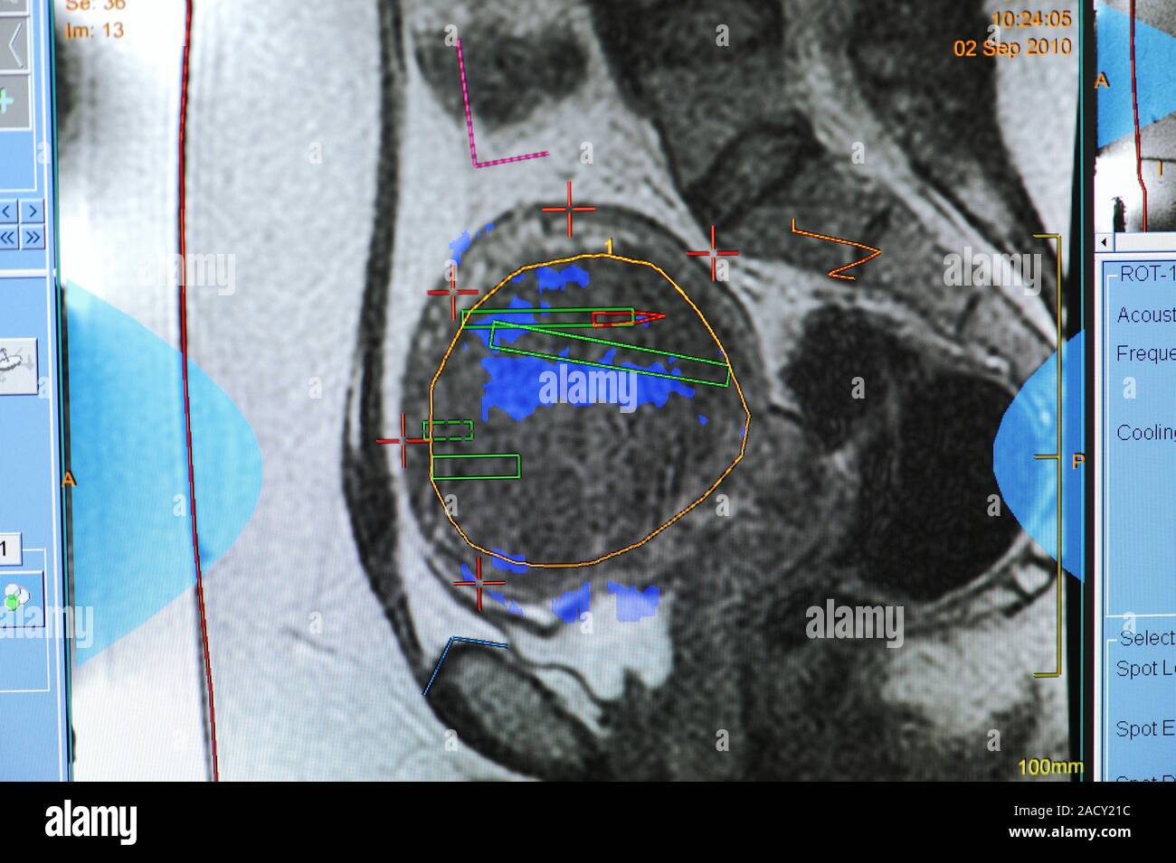 MRI directed ultrasound fibroid treatment. MRI (magnetic resonance ...