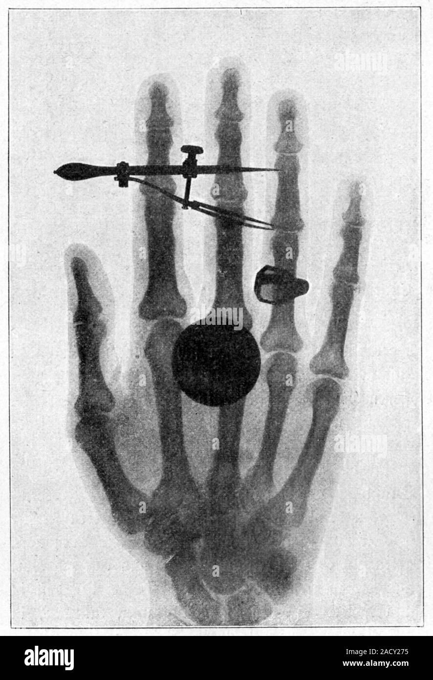 Female hand. 19th Century X-ray of the hand of the German Physicist ...