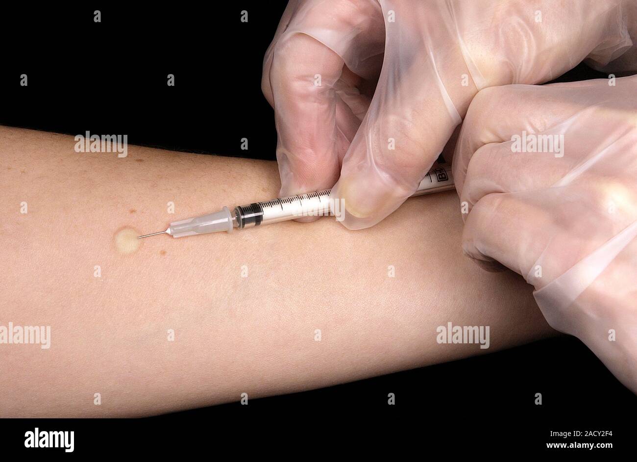 Mantoux tuberculin skin test. Technician placing a Mantoux tuberculin ...