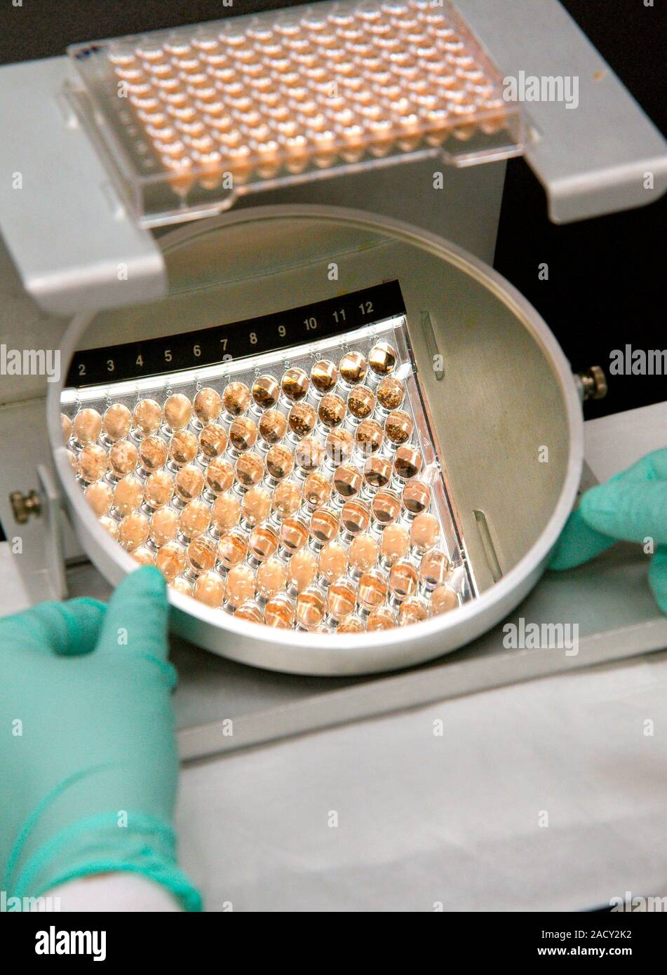 Fungal meningitis research. Scientist reviewing the results of a test ...