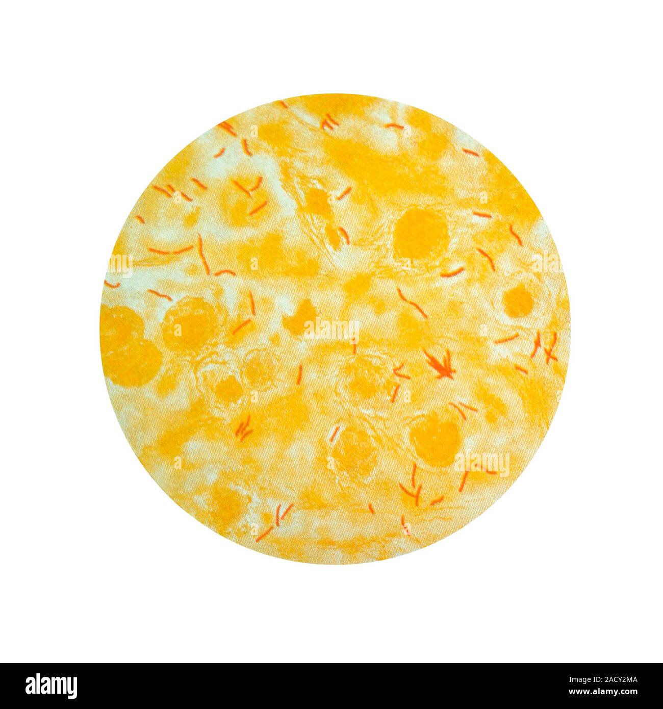 Tuberculosis bacteria. Light micrograph of a sputum (spit, mucous ...