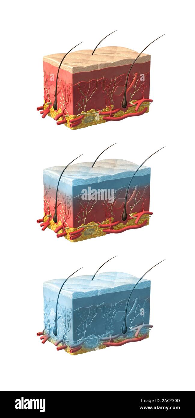 Frostbite. Computer artwork showing (from top) the first, second and ...