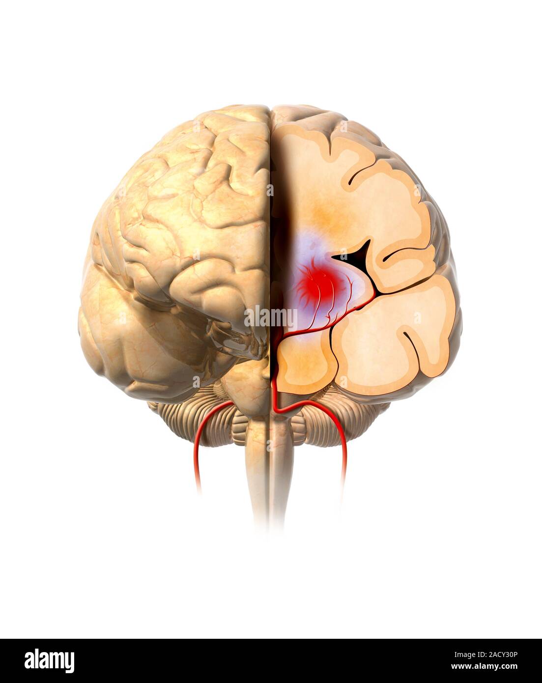 Brain haemorrhage. Cutaway computer artwork of a human brain, showing ...