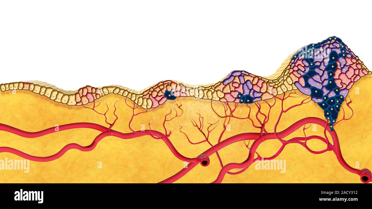 Development of cancer. Computer artwork showing normal healthy skin ...