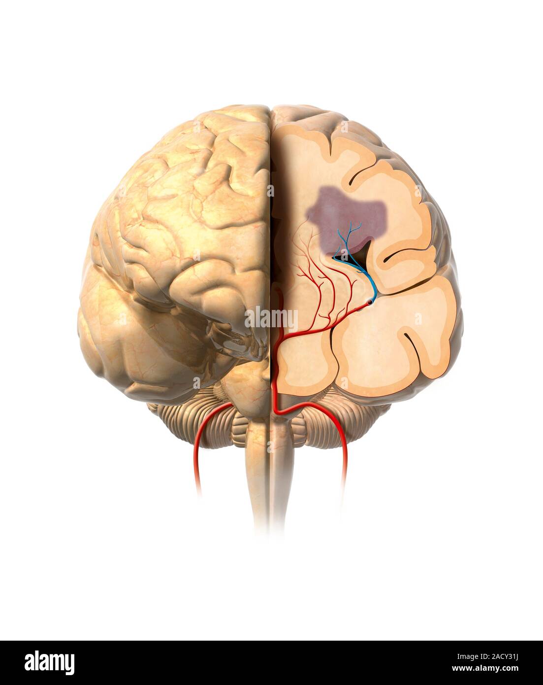 Stroke, computer artwork. A stroke, or cerebrovascular accident (CVA ...