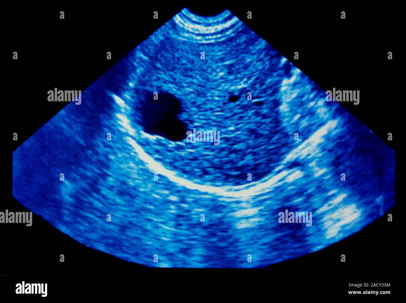 Liver Cyst Coloured Ultrasound Image Of A Cyst Dark Centre Left In The Liver Of A Patient