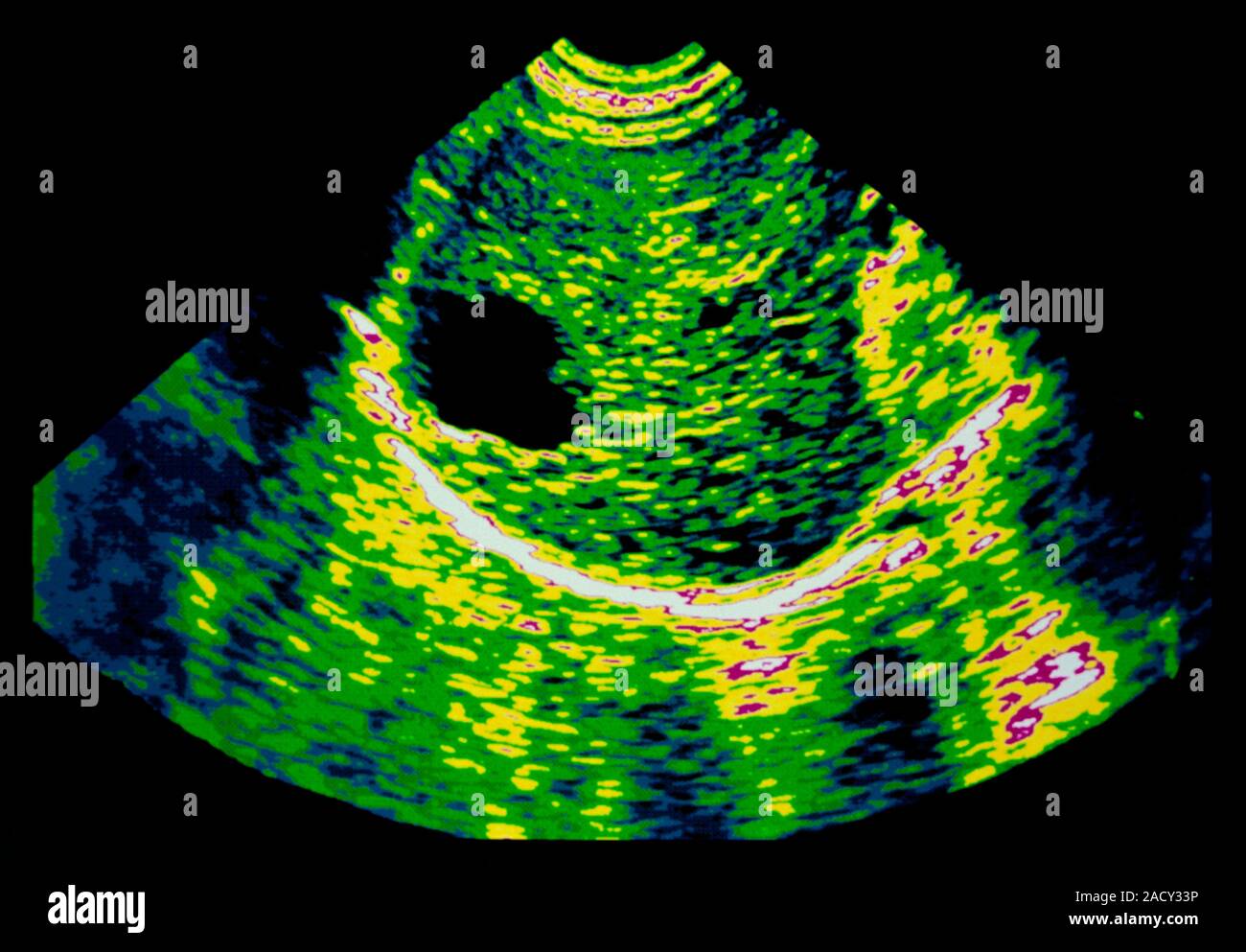 Liver cyst. Coloured ultrasound image of a cyst (dark, centre-left) in ...